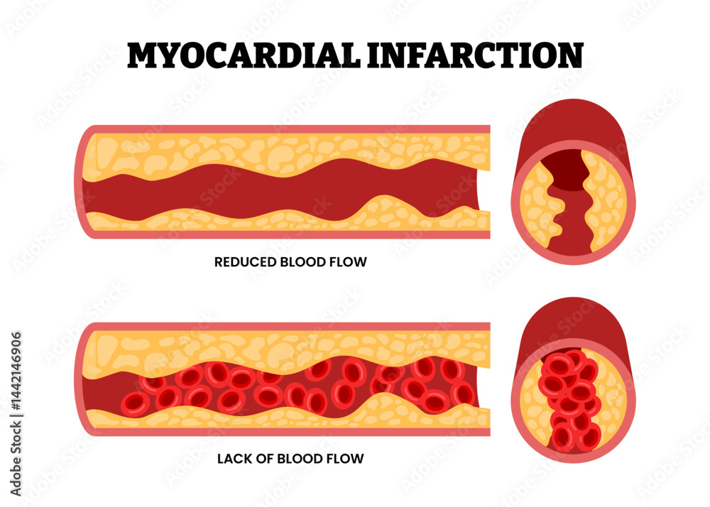Стоковое векторное изображение «Myocardial Infarction, educational ...
