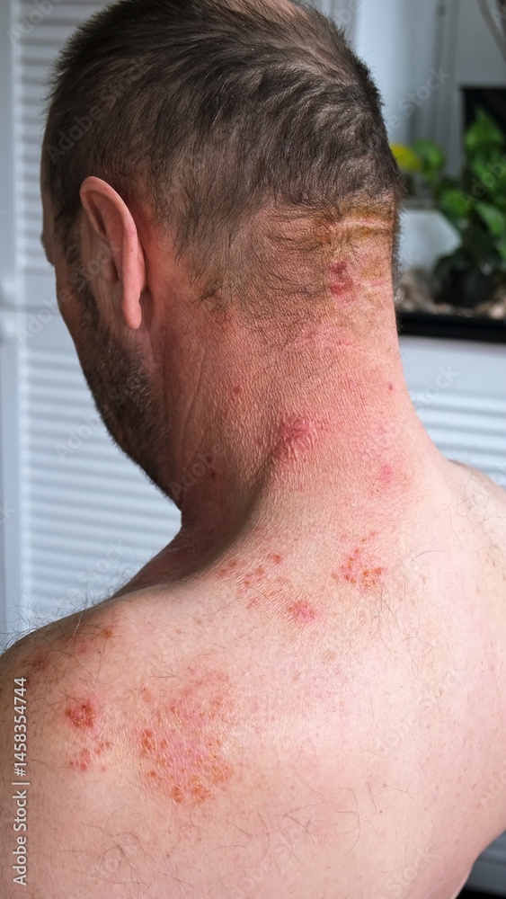 Skin lesion symptom in Shingles or Herpes zoster in person. Viral ...