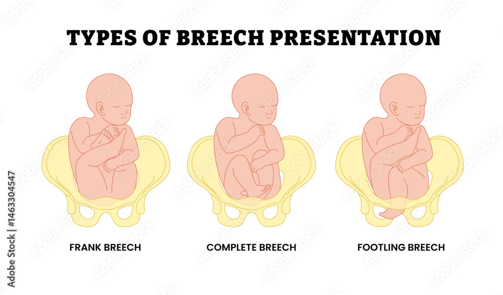 Different types of breech presentation types, educational medical ...