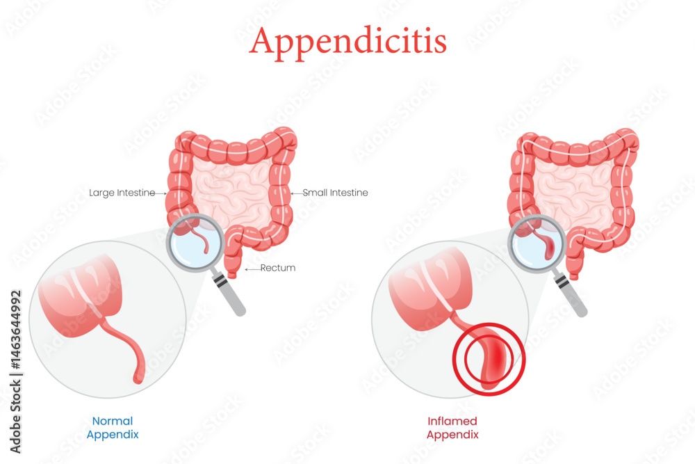 Diagram of Normal and Inflamed Appendix Showing Appendicitis ...