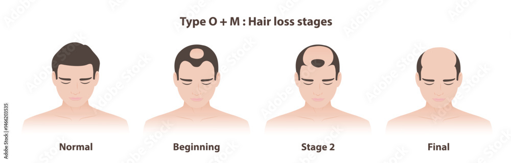 Type O and M hair loss stages in male pattern baldness illustration ...