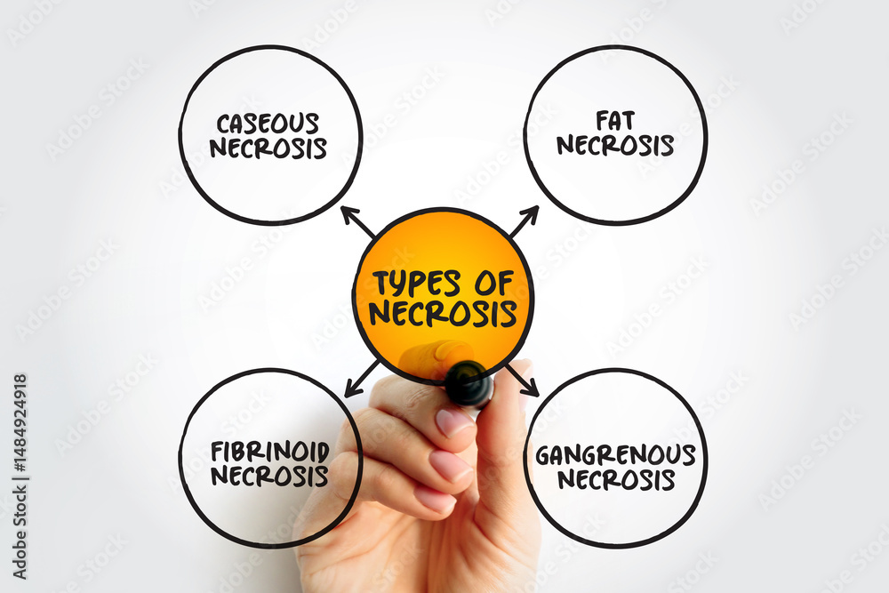 Types of Necrosis (death of body tissue) mind map text concept for ...