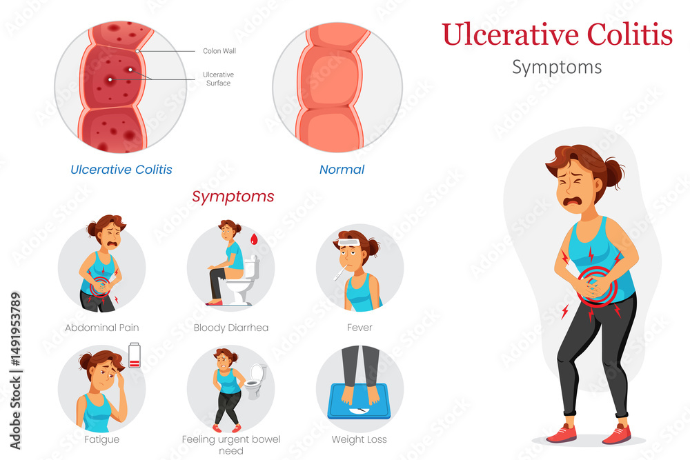 Healthy vs Ulcerative Colitis Intestine Diagram Showing Symptoms Stock ...