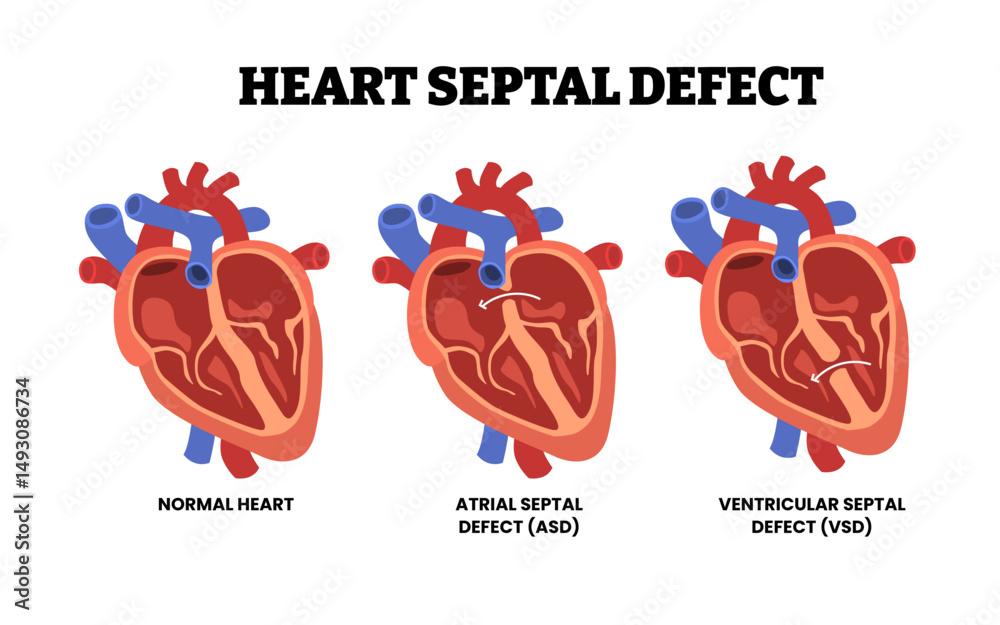 Heart Septal Defect, educational medical poster design healthcare ...