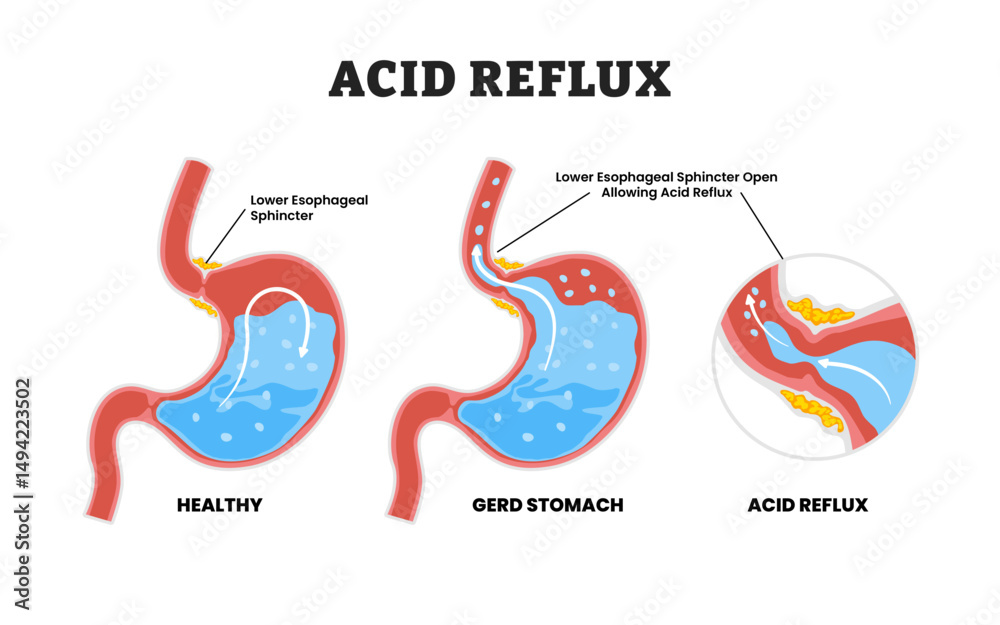 Acid reflux or GERD or Gastroesophageal reflux stomach disease ...