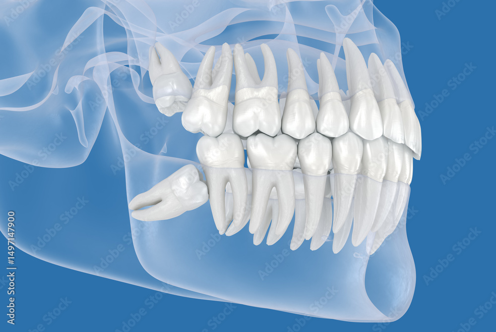 Impaction of Wisdom tooth. Dental 3D illustration Stock Illustration ...