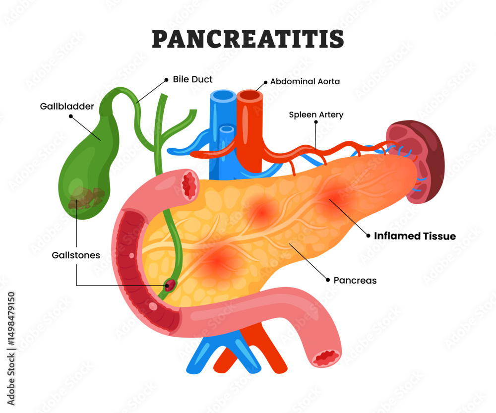Pancreatitis or Pancreas Inflammation, educational medical poster ...