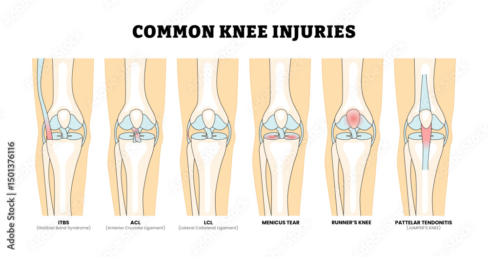 Different types of common knee injury types, educational medical poster ...
