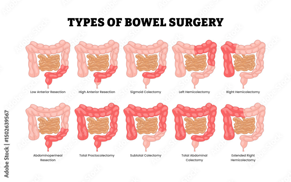 Different types of bowel surgery types, educational medical poster ...
