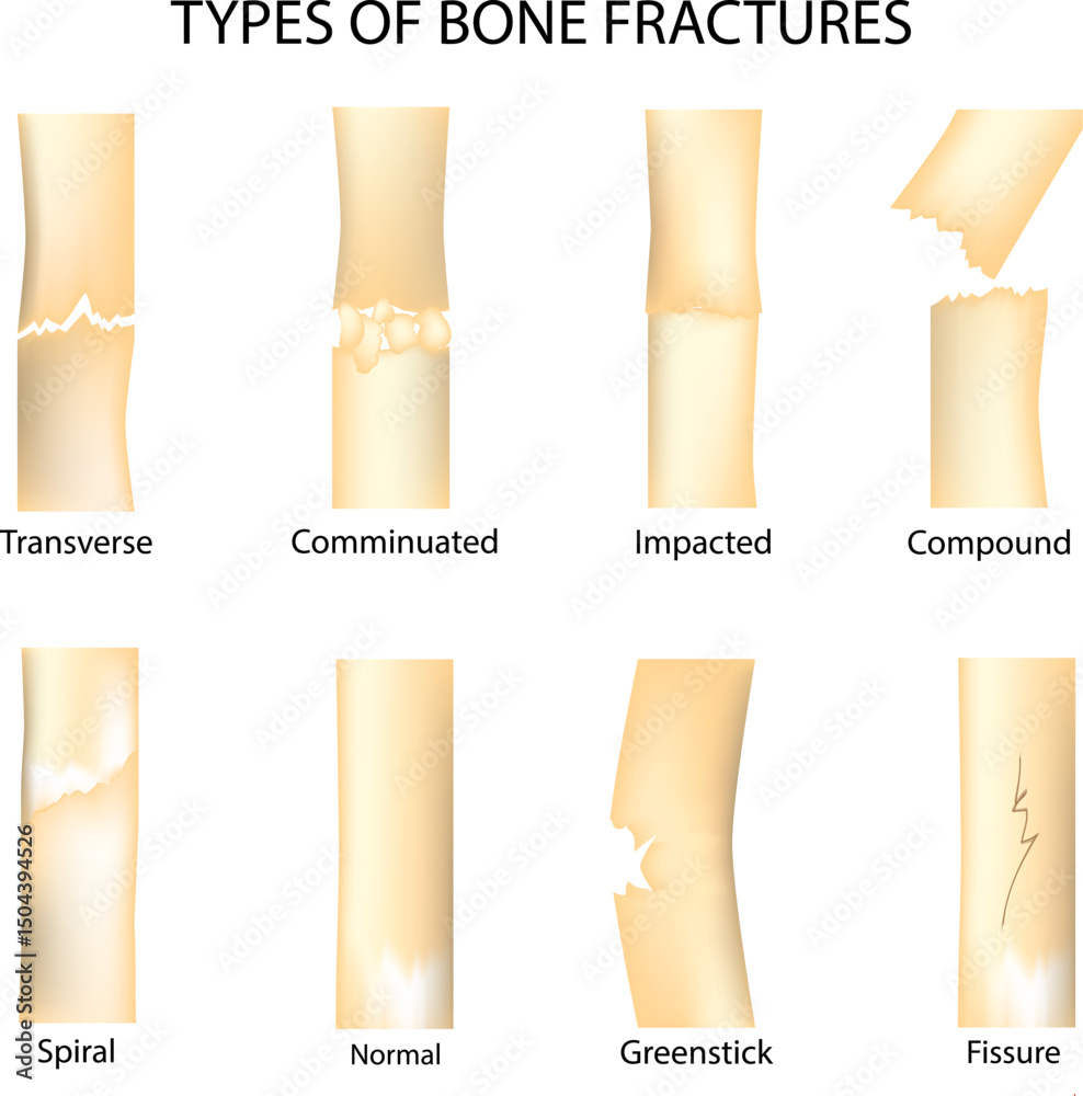 Anatomical medical illustration showing various types of bone fractures ...