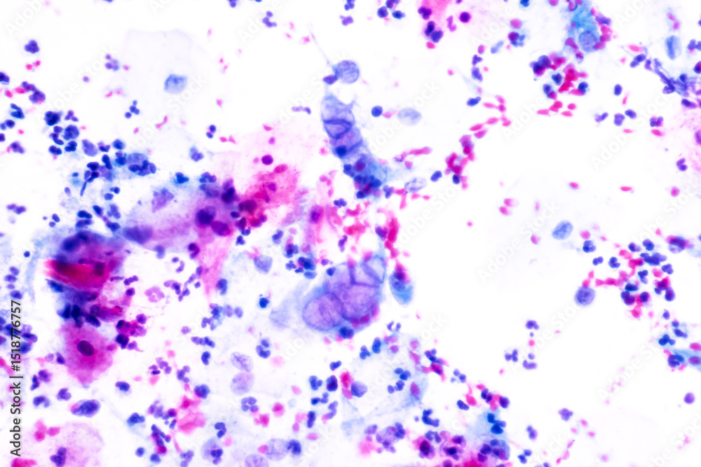 Genital herpes infection by the herpes simplex virus (HSV) of the ...