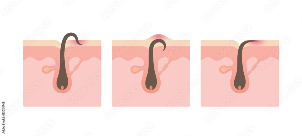 Types of ingrown hair. Hair has grown back into the skin surface ...