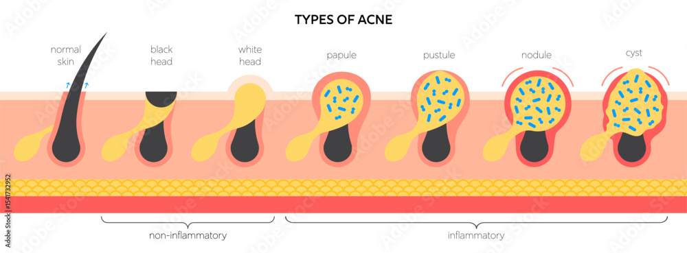 Vektor Acne types medical vector infographic. Acne vulgaris in skin ...