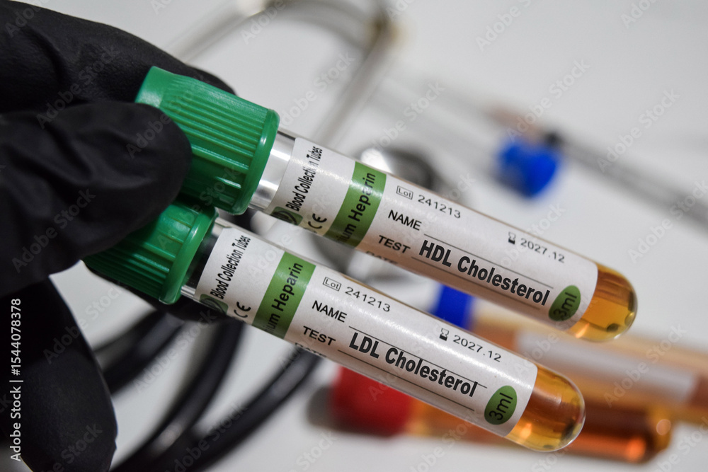 HDL Cholesterol - Test and LDL Cholesterol - Test with blood sample ...