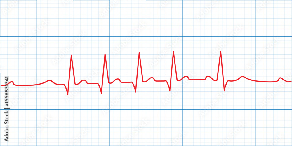 Medical heart rate monitoring displayed on an ECG or EKG graph with a ...