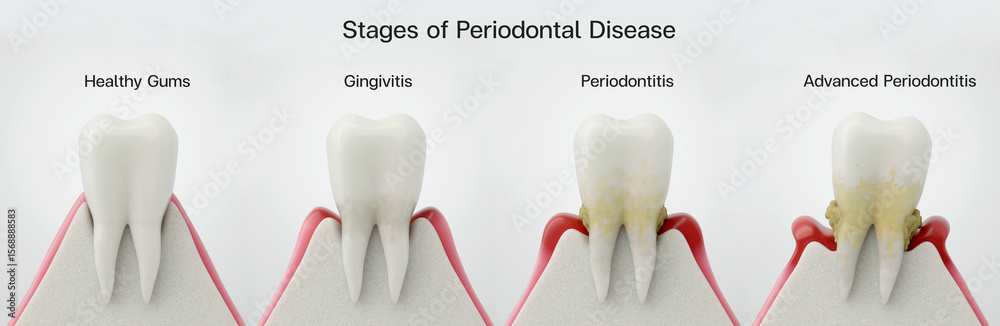 Stages of Periodontontal Disease, from Healthy Gums to Advanced ...