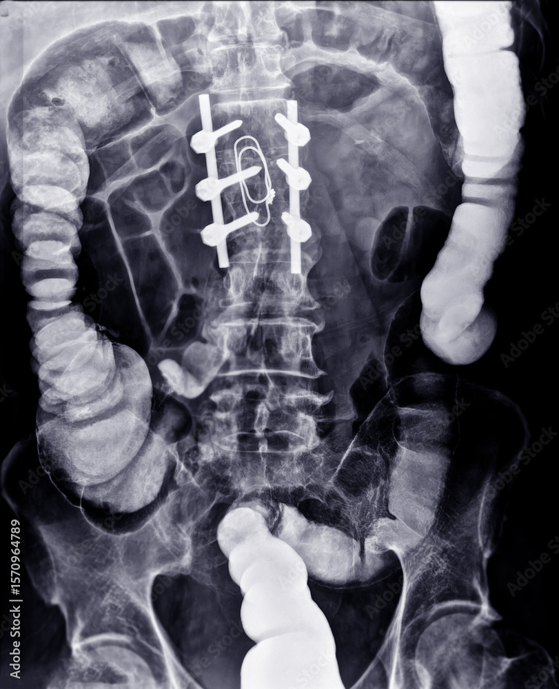 Double contrast barium enema showing mild scoliosis in the lumbar spine ...