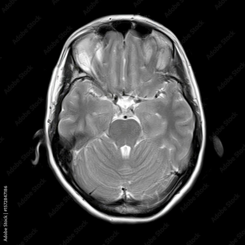 Axial T2-weighted MRI of a 40-year-old patient at the lower brainstem ...