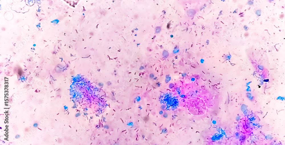 Mycobacterium tuberculosis positive (small red rod) in sputum smear ...