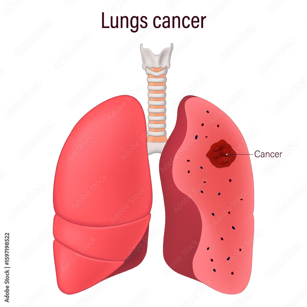 Lungs Cancer. Lung anatomy for Disease. Human respiratory system. Stock ...