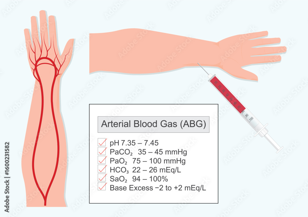 An arterial blood gas (ABG) test measures the oxygen and carbon dioxide ...