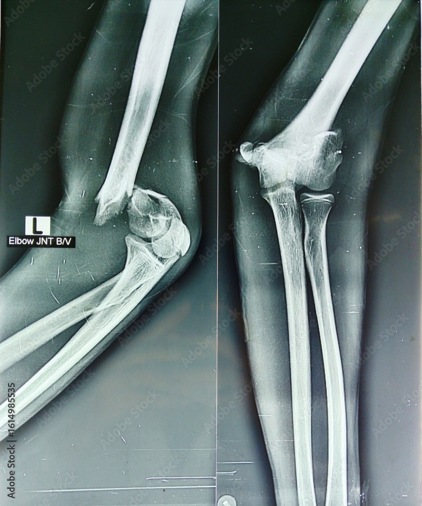 X ray image of elbow joint antero-posterior and lateral view showing ...