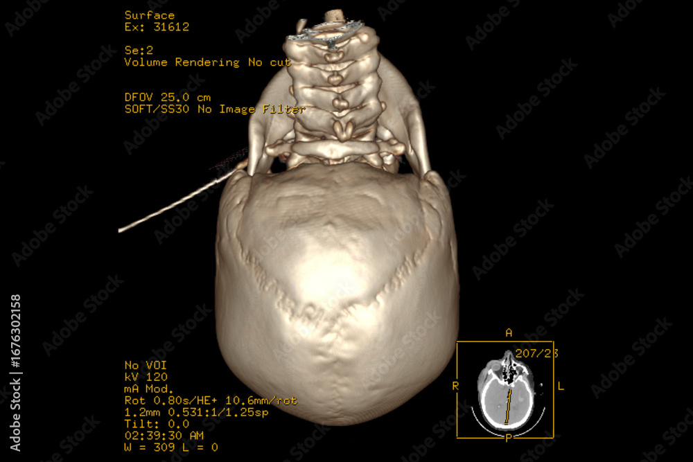 Medical themes: CT Scan of Intraparenchymal hematoma in the left basal ...
