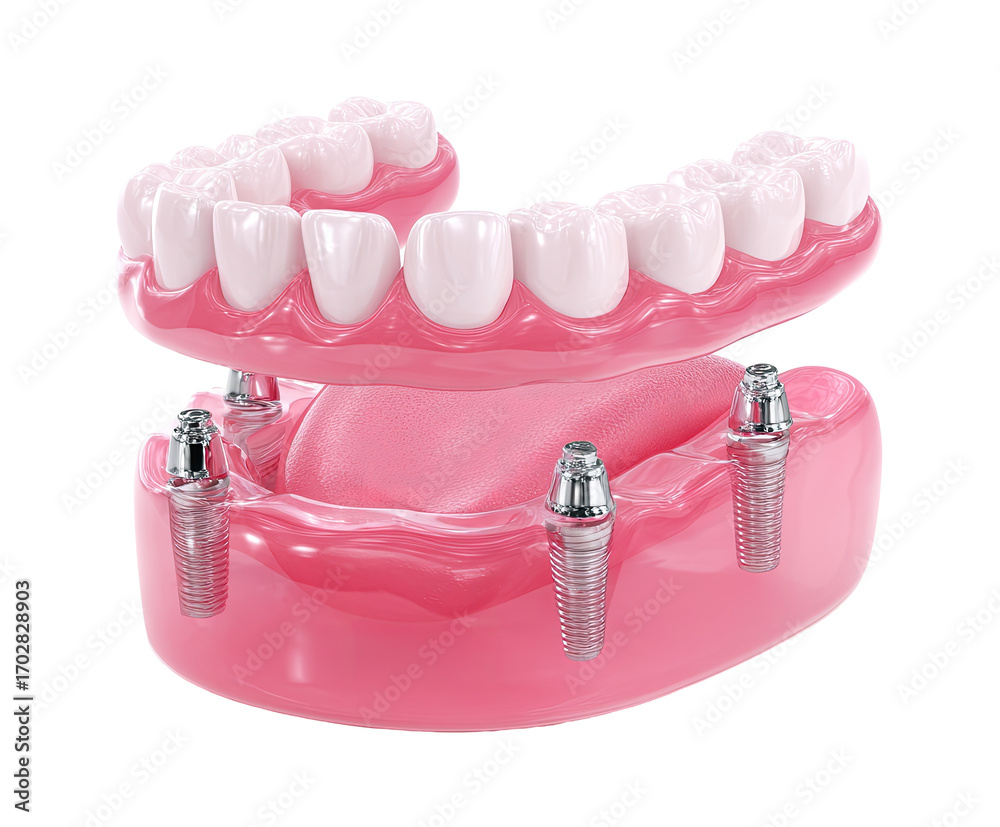 Dental implant-supported denture. Pink denture with teeth and metal ...