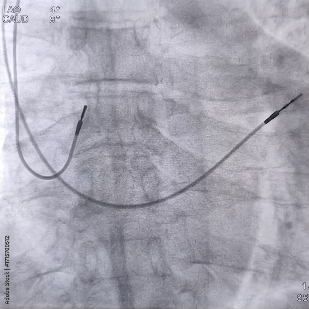 X ray image showed dual chamber permanent pacemaker (PPM) leads in left ...