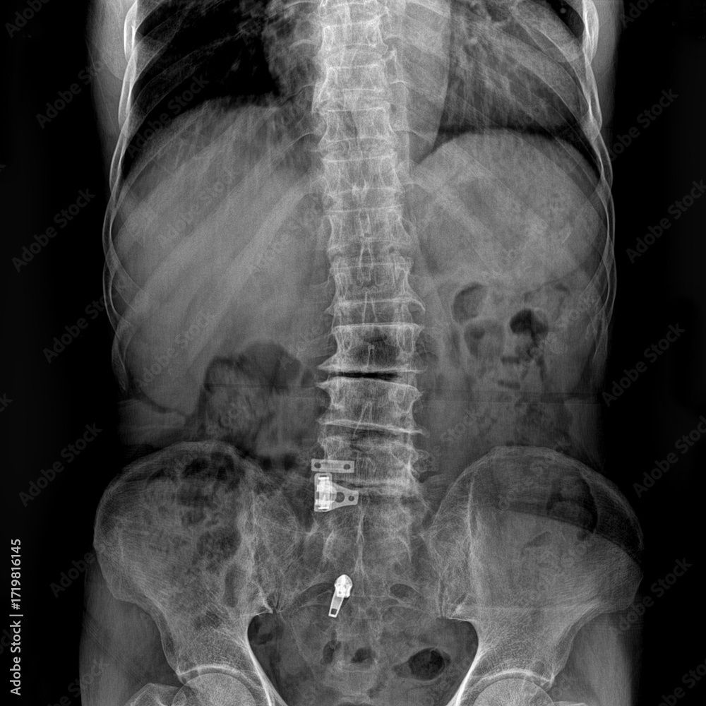 This image is an abdominal X-ray, also known as an abdominal radiograph ...