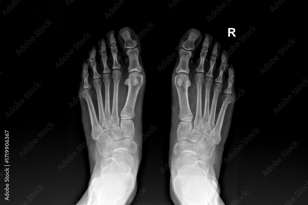 Fotografie X-ray image of human feet showing bones, joints, toes and ...
