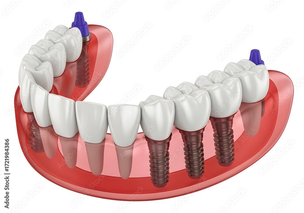 Close up of a dental arch with implants and teeth in a transparent gum ...
