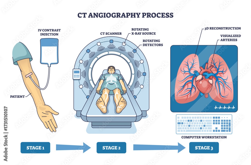 Vector de Stock CT angiography process shows IV contrast injection, CT ...
