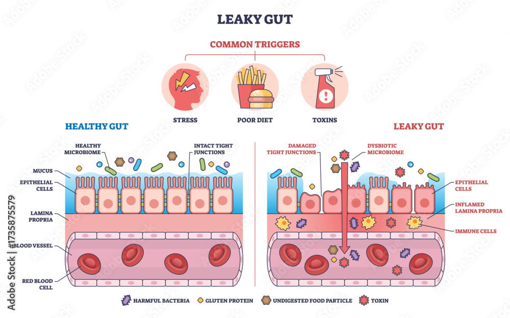 Leaky gut diagram shows healthy vs damaged gut lining, highlighting ...