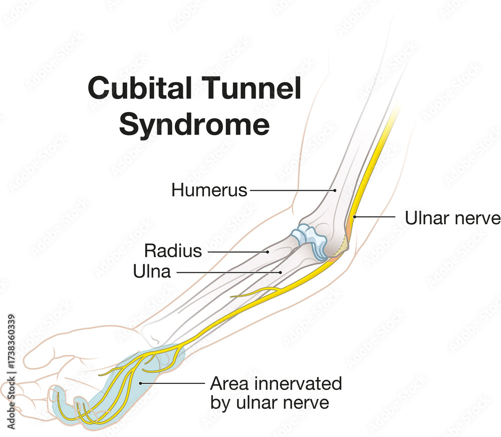 Cubital Tunnel Syndrome. Illustration of Ulnar Nerve Compression in the ...