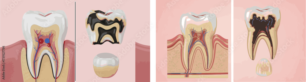 Dental Decay and Root Canal Illustration | Tooth Cavity Diagram for ...