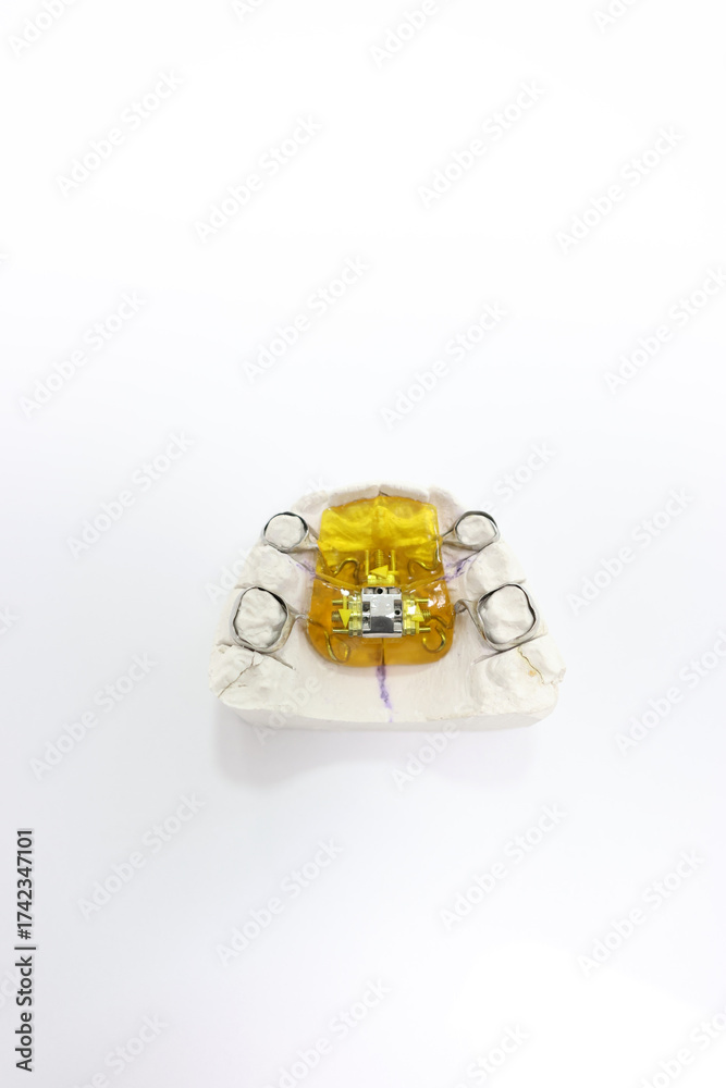 Mandibular teeth cast. Obtaining a cast of the dental arch for the ...