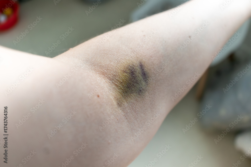 Bruise on arm after blood test, hematoma Stock Photo | Adobe Stock