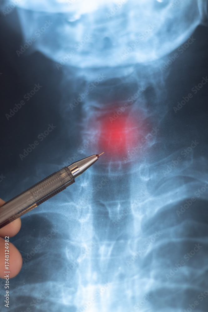 Doctor learning vertical X-ray scan with displacement of intervertebral ...