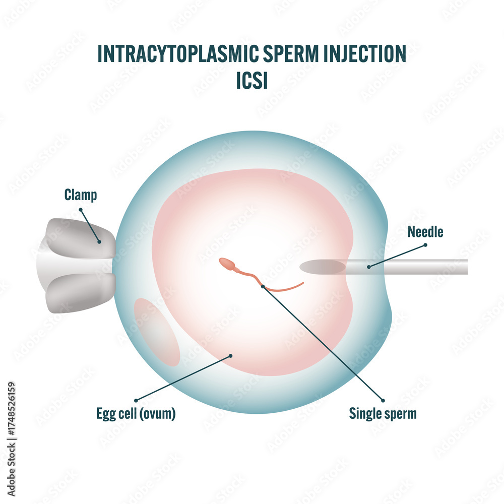 Labeled intracytoplasmic sperm injection ICSI diagram — educational ...