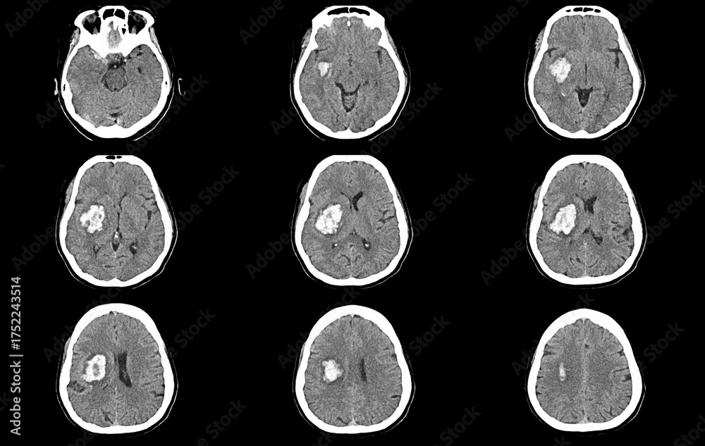 CT scan brain image showing intracerebral hemorrhage stroke Stock Photo ...