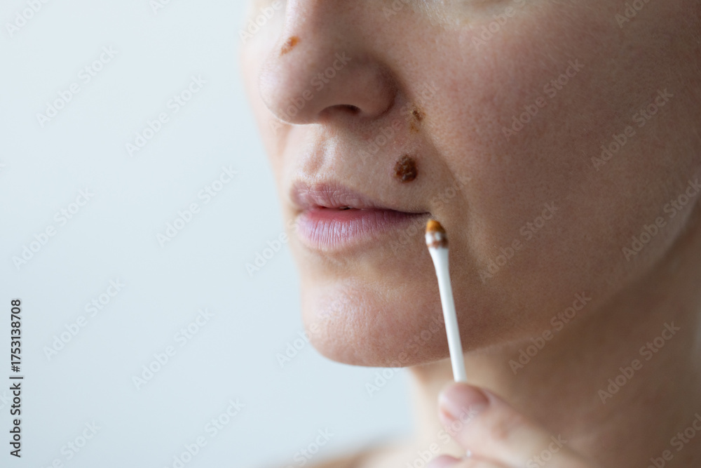 Beauty spot above the lips. Wound after removal a mole above the lips ...