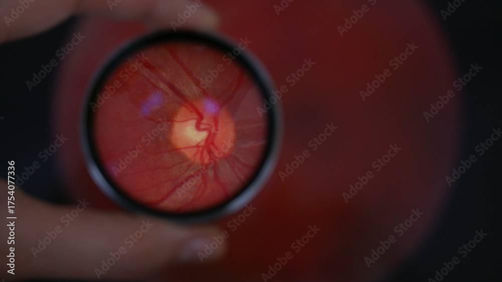 View of optic disc during examination of retina while holding 20 ...