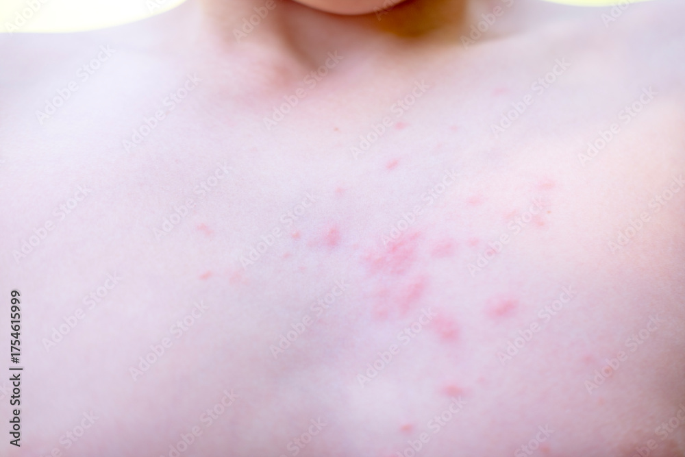 human skin covered in red, itchy rash, 11-year-old child with multiple ...