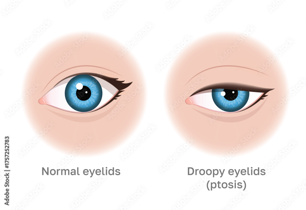 Normal Eyelids vs. Droopy Eyelids: A Simple Ptosis Illustration. Image ...