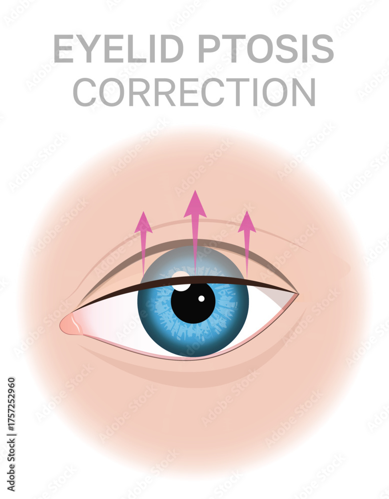Eyelid Ptosis Correction Concept Illustration.Upper blepharoplasty. Can ...