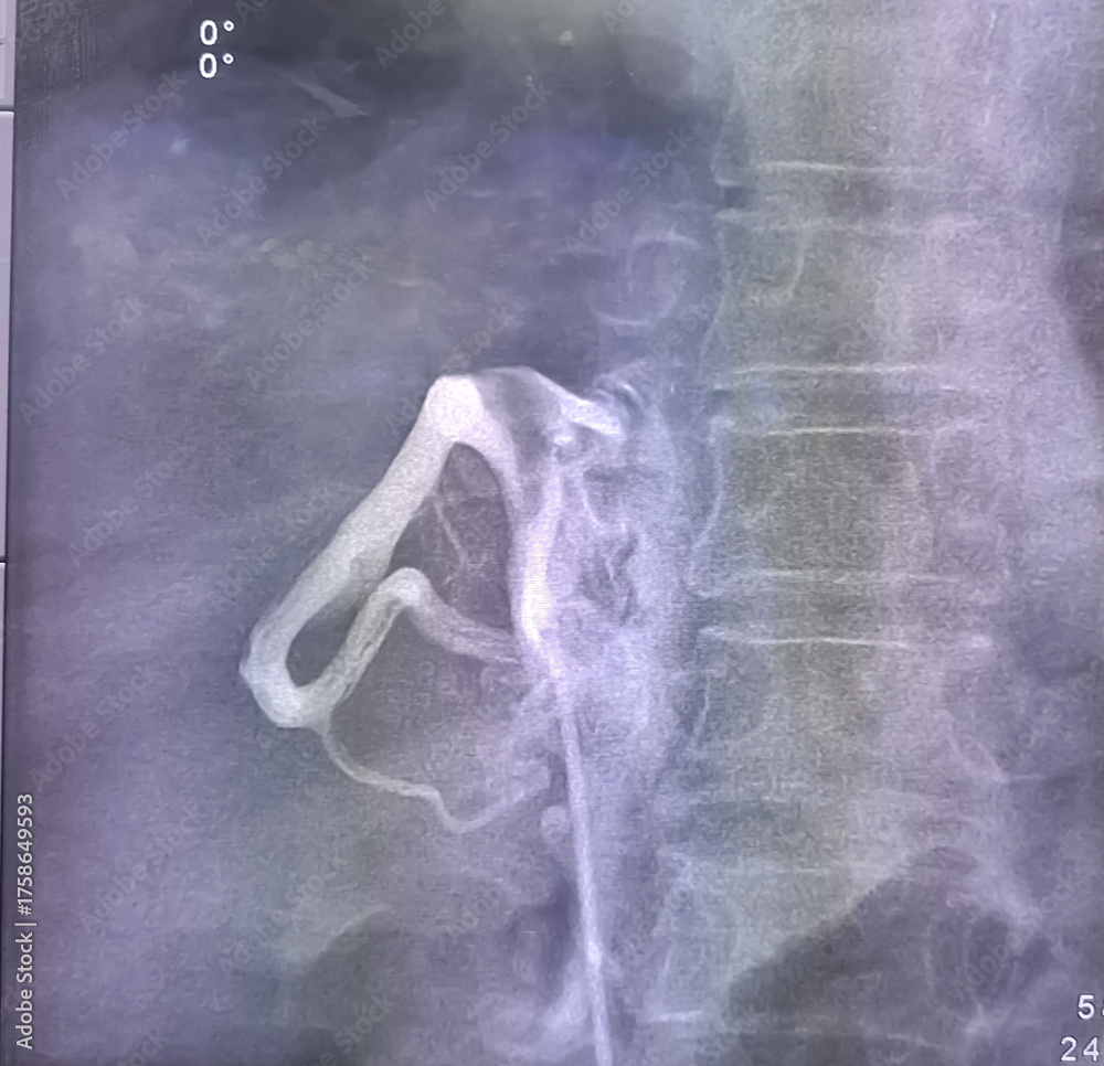 Venogram by cath lab showing hypoplastic left transverse sinus vein ...