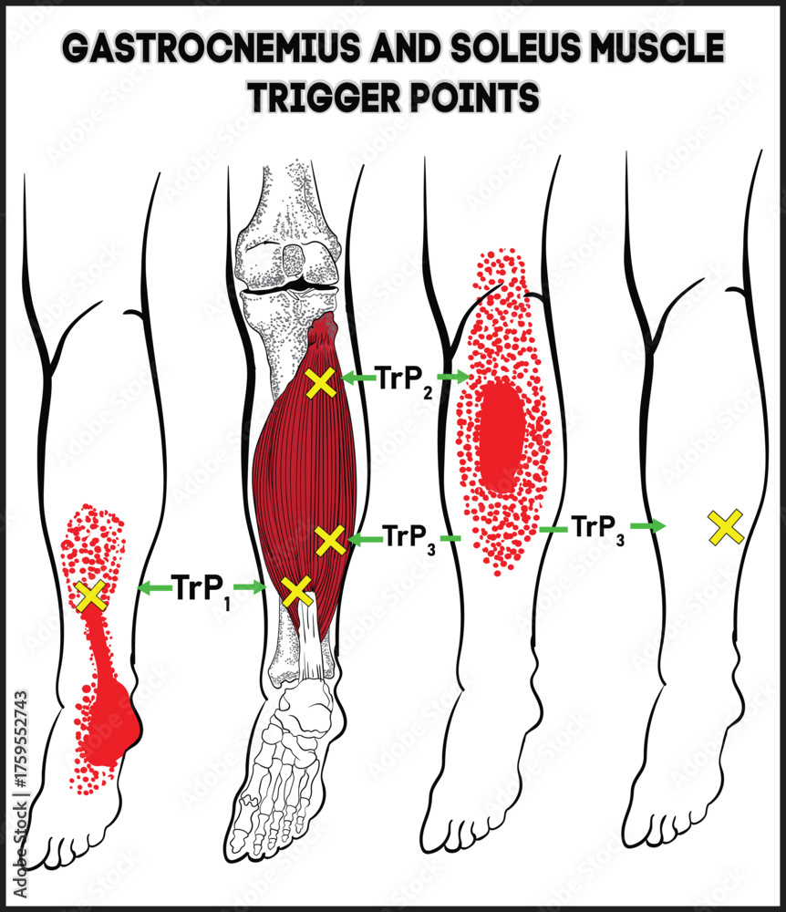 Stock-Vektorgrafik „Gastrocnemius and Soleus Muscle Trigger Points and ...