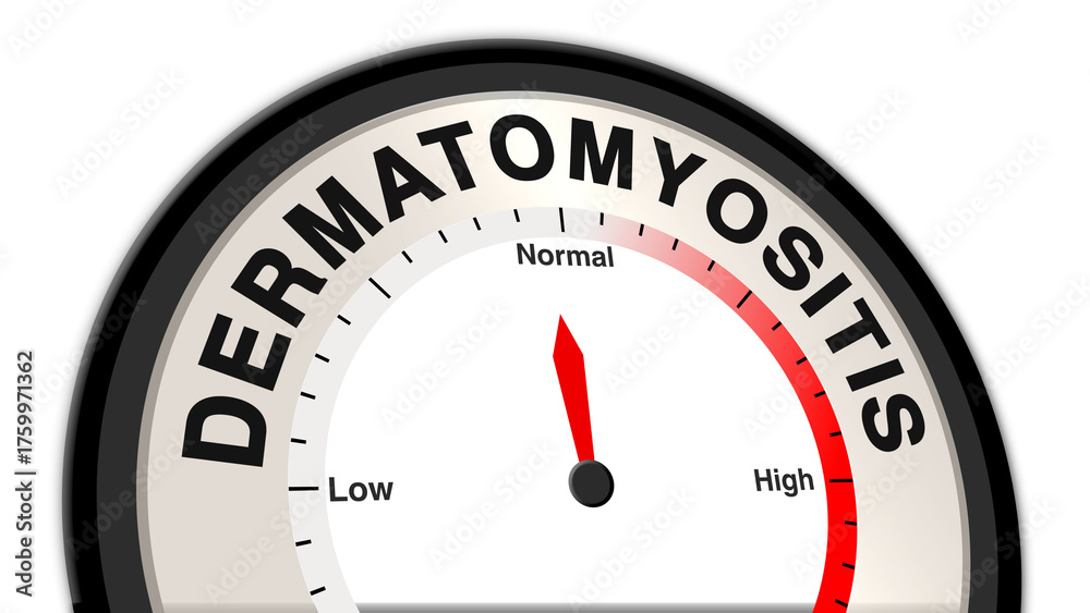 Dermatomyositis at normal severity shown on a barometer or tachometer ...