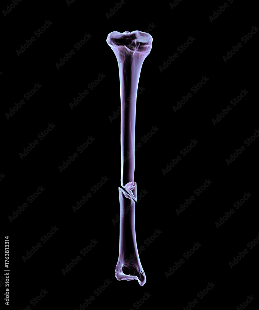 Tibia shaft fracture, 3D illustration. Shows a break in the tibial ...